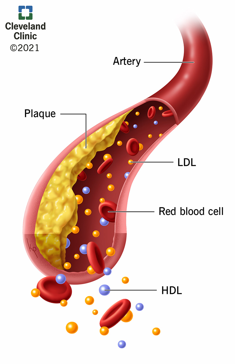 Hiperlipidemija (padidėjęs Cholesterolio Kiekis): Lygiai, Priežastys ...